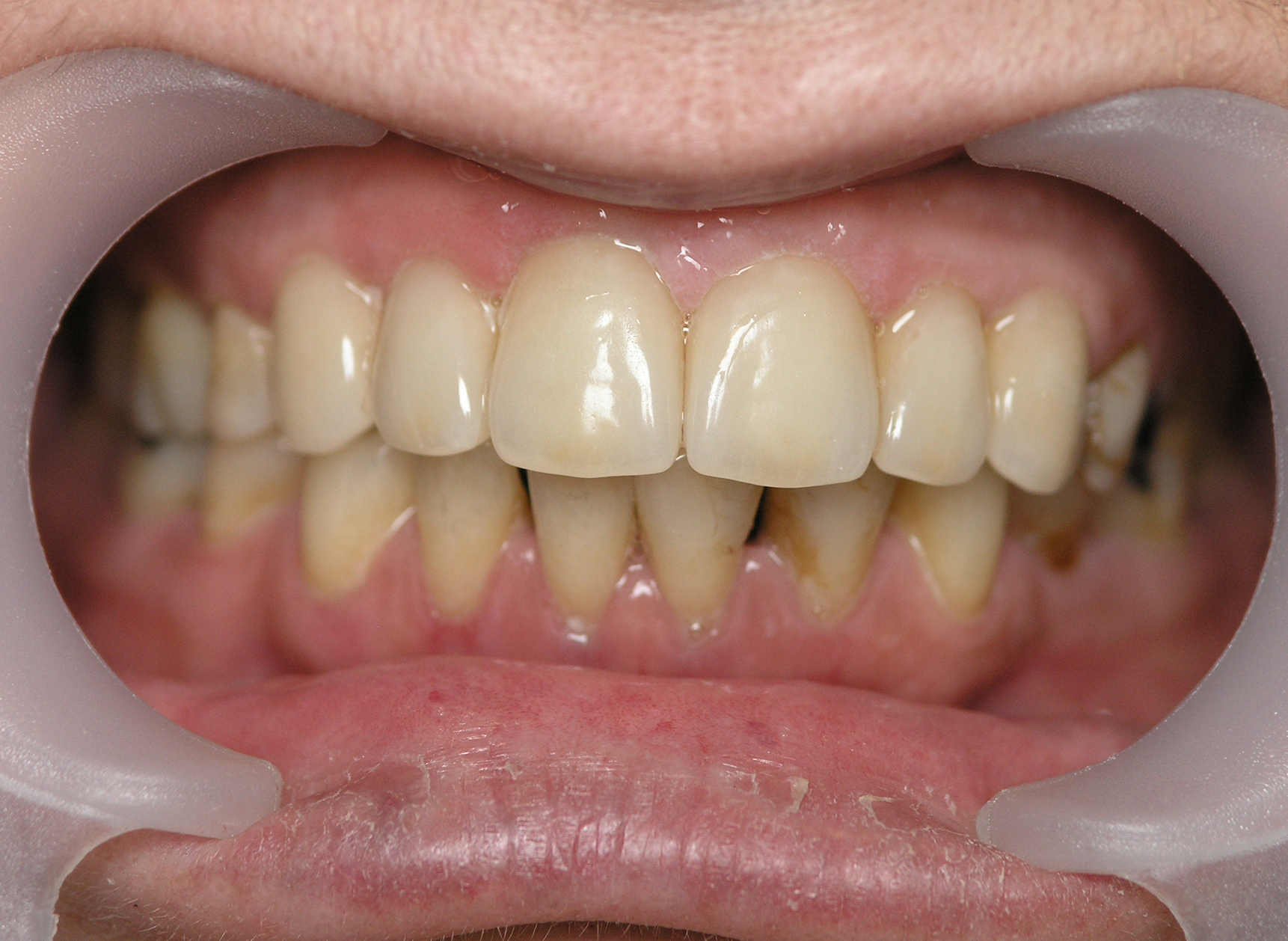 dental services: Implant Bridge | Gippsland Prosthodontics