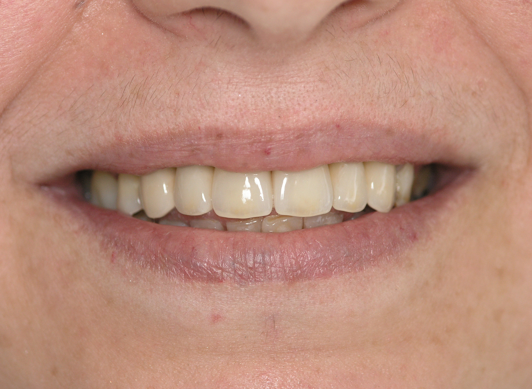 dental services: Implant Bridge | Gippsland Prosthodontics