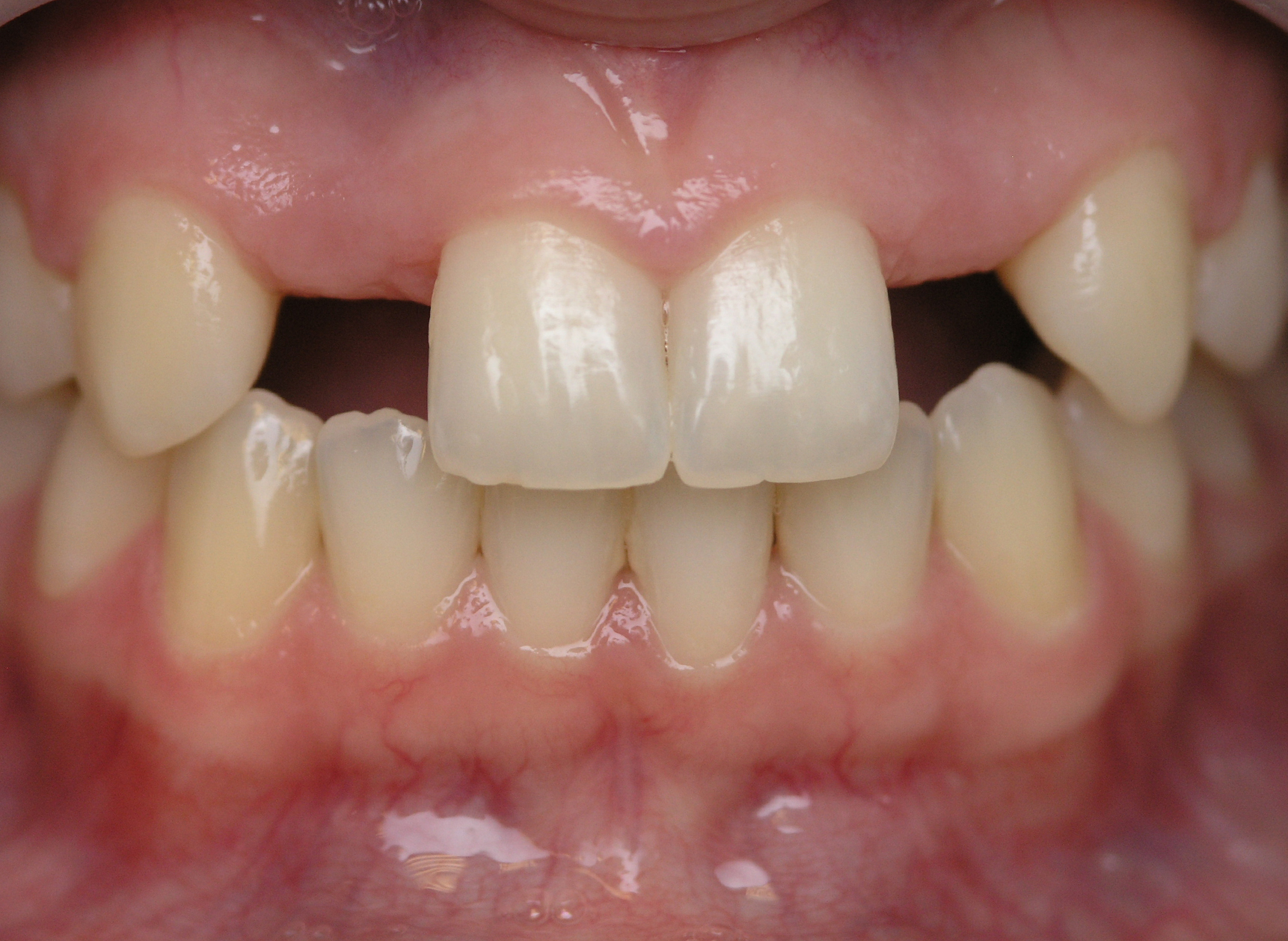 dental services: Resin Bonded Bridges | Gippsland Prosthodontics